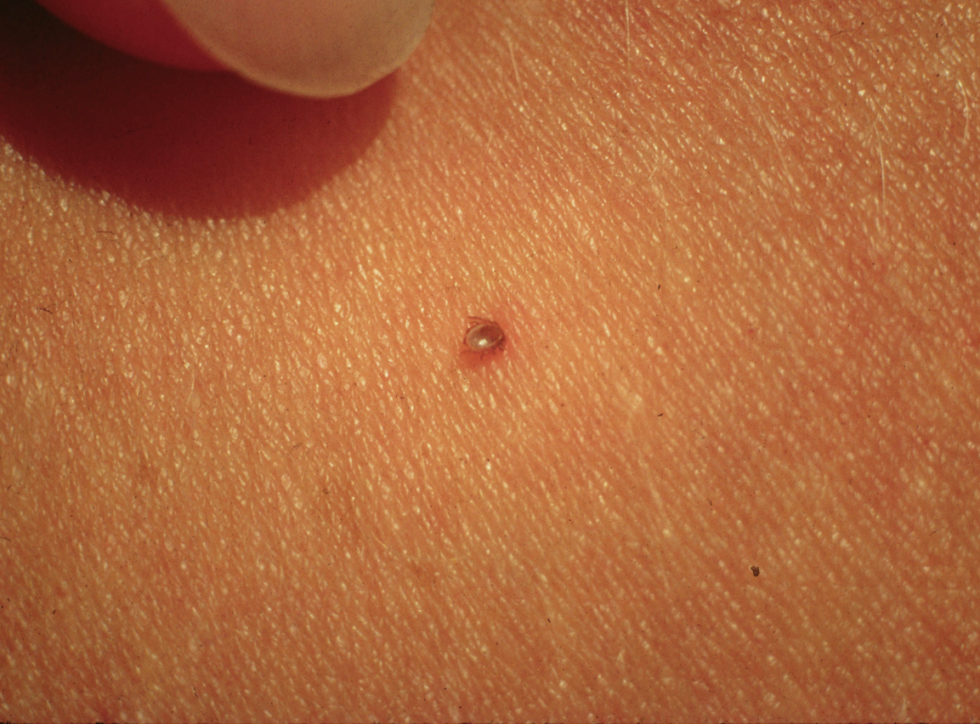 Tick Identification and Information | American Lyme Disease Foundation