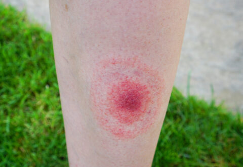 Lyme Disease | American Lyme Disease Foundation
